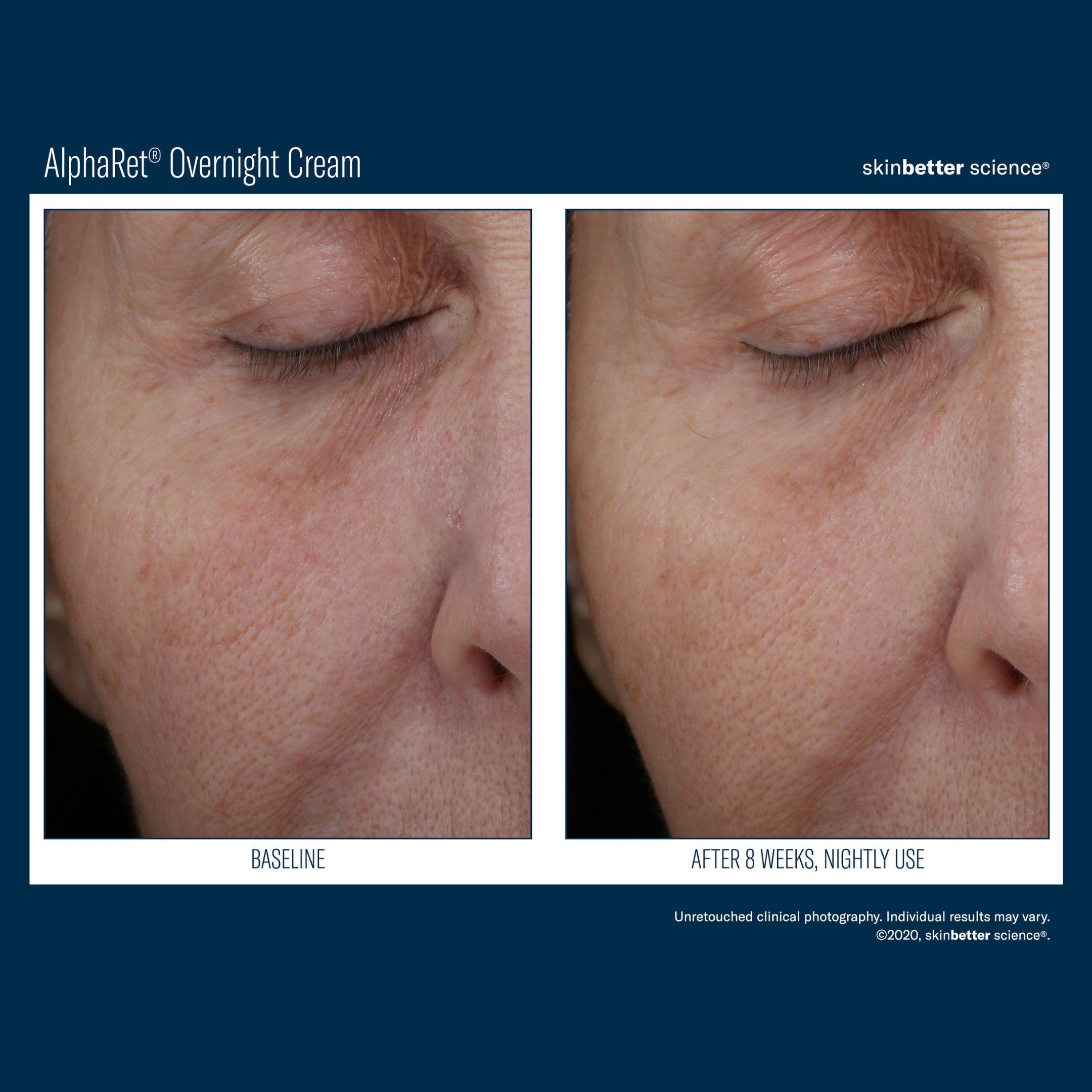 Skinbetter Alpharet Overnight Cream – SavvyDerm